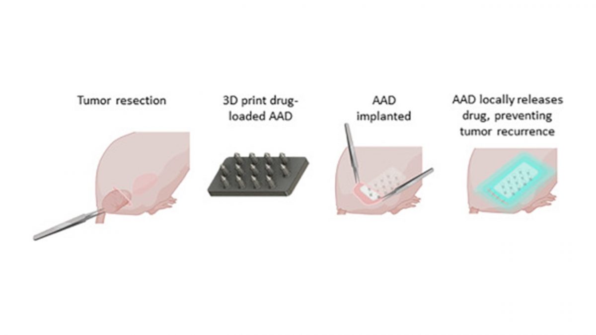 NAMIC - 3D Printed Drug-loaded Implantable Devices for Intraoperative ...